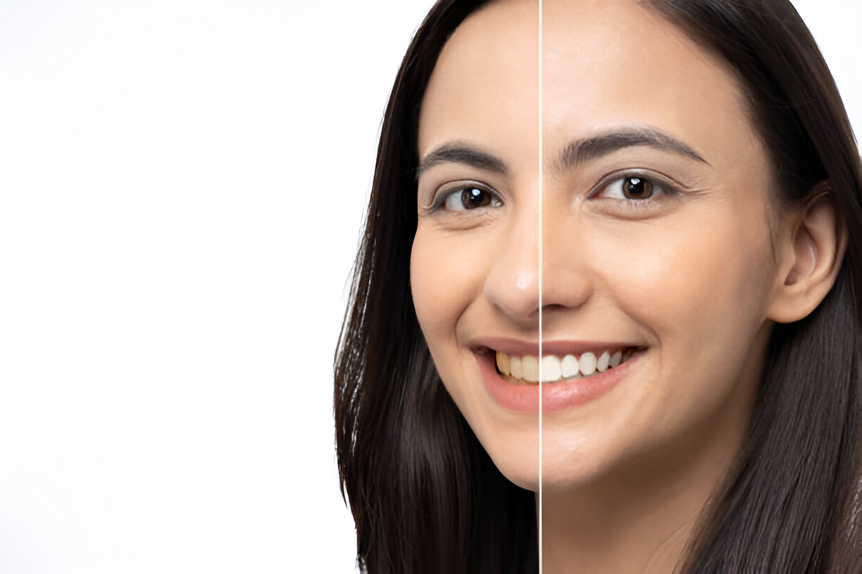 Can Teeth Whitening Be Done on the NHS?