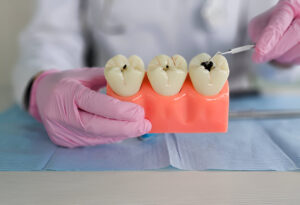 How Does Dental Filling Work
